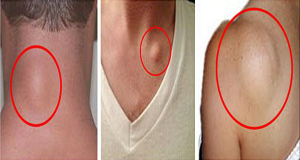 Get Rid Of Skin Lumps Naturally | Extreme Natural Health News